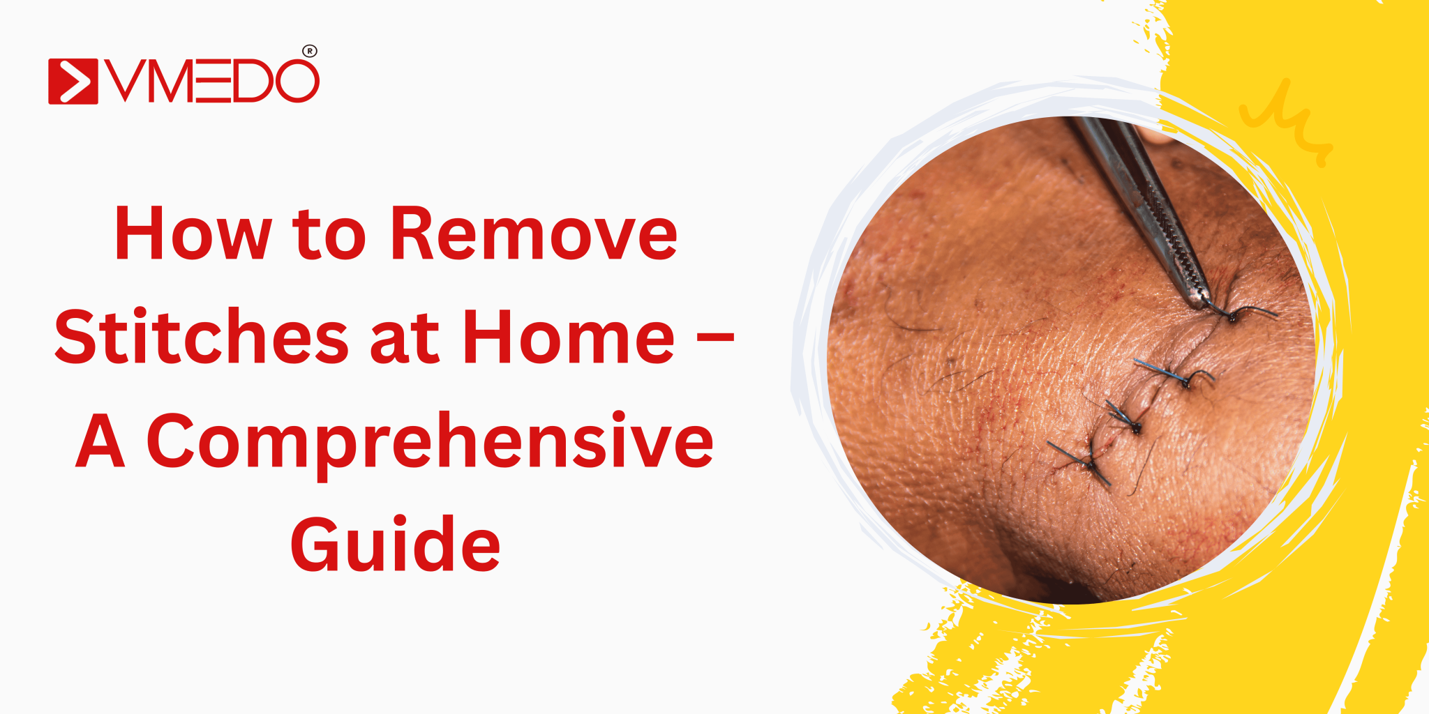 How to Remove Stitches at Home – A Comprehensive Guide - VMEDO Blog