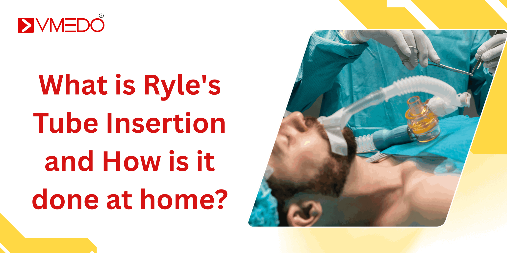 What is Ryle's Tube Insertion and How is it done at home? - VMEDO Blog